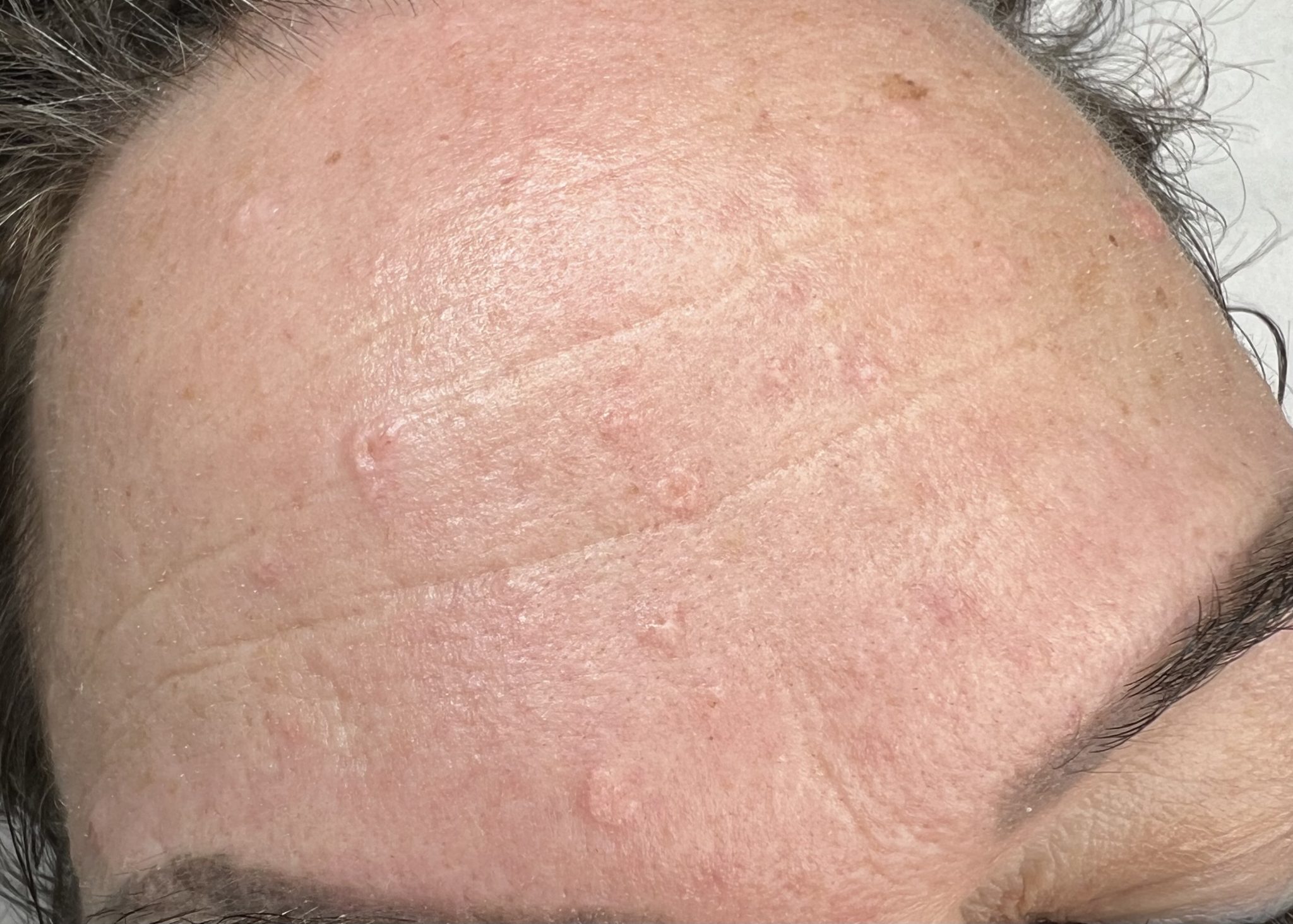 Sebaceous Hyperplasia