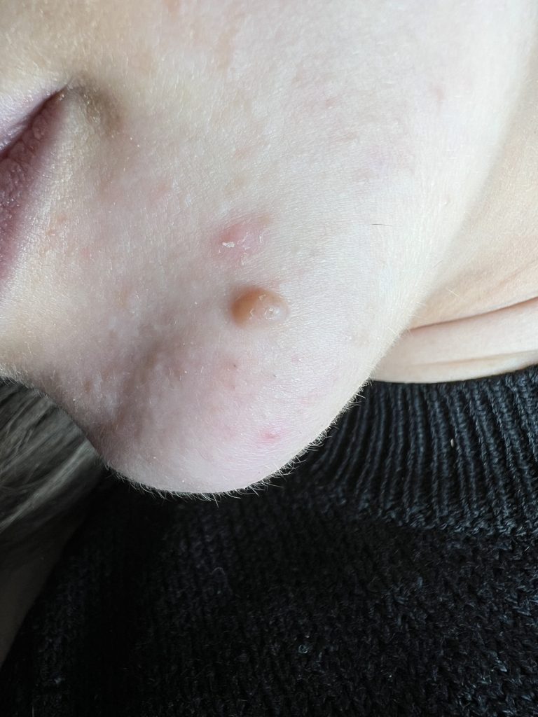 The Importance of Getting Your Mole Checked Before Treatment