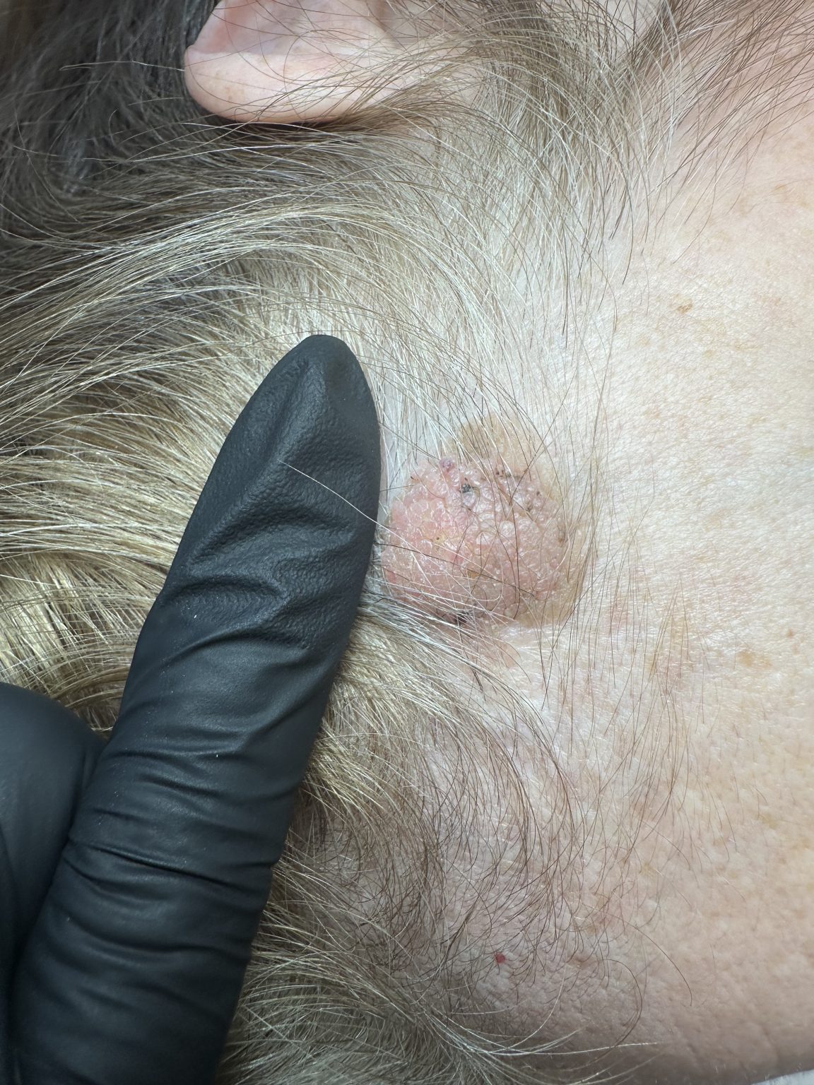 Seborrheic Keratosis: Why It Appears So Differently on Our Skin