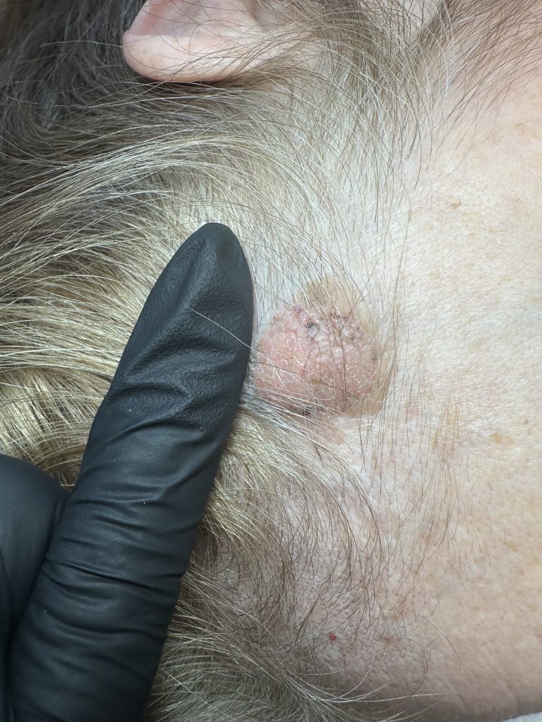 Seborrheic Keratosis: Why It Appears So Differently on Our Skin