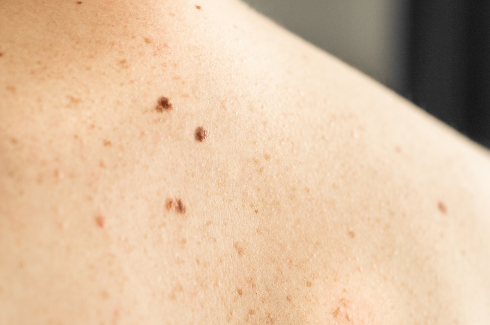 Dermatosa Papulosa Nigra Colchester & Chelmsford | Amy Gordon