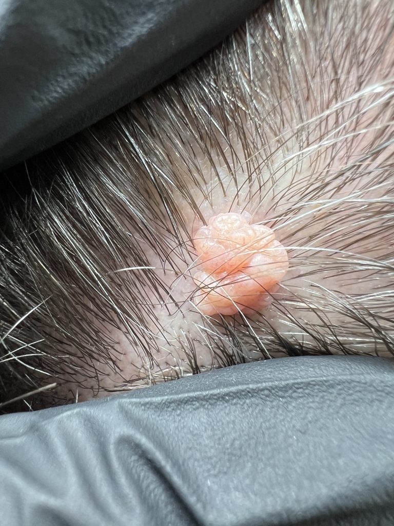 Intradermal Neavus - Scalp