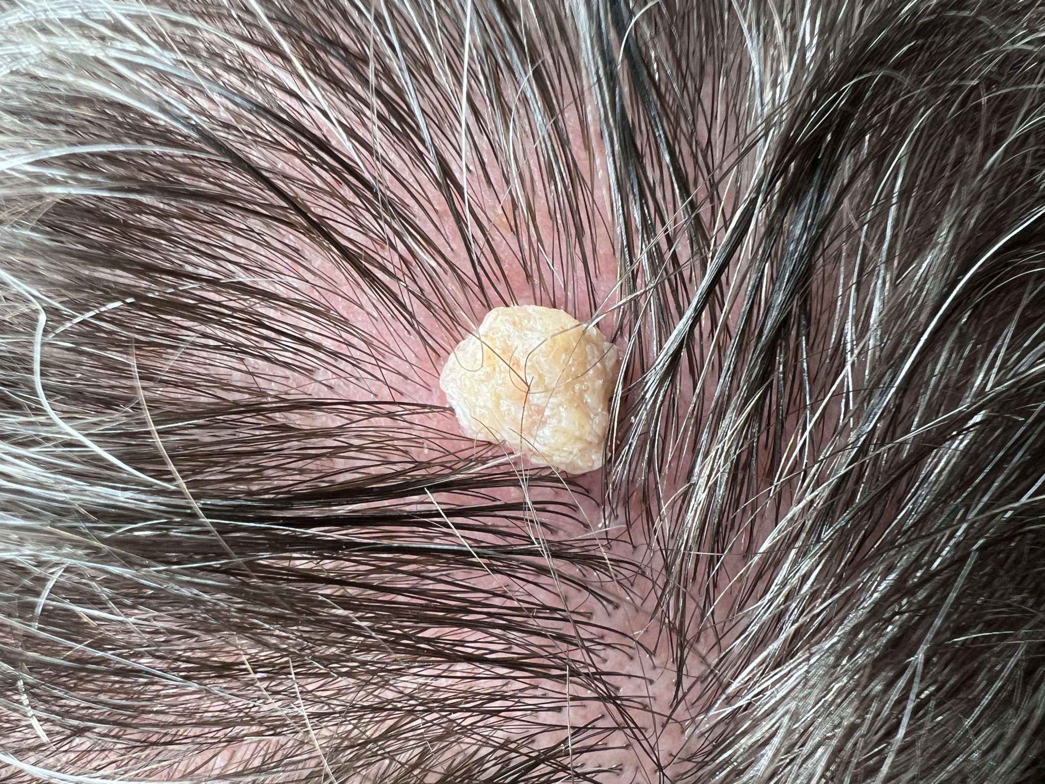 Intradermal Neavus - Scalp