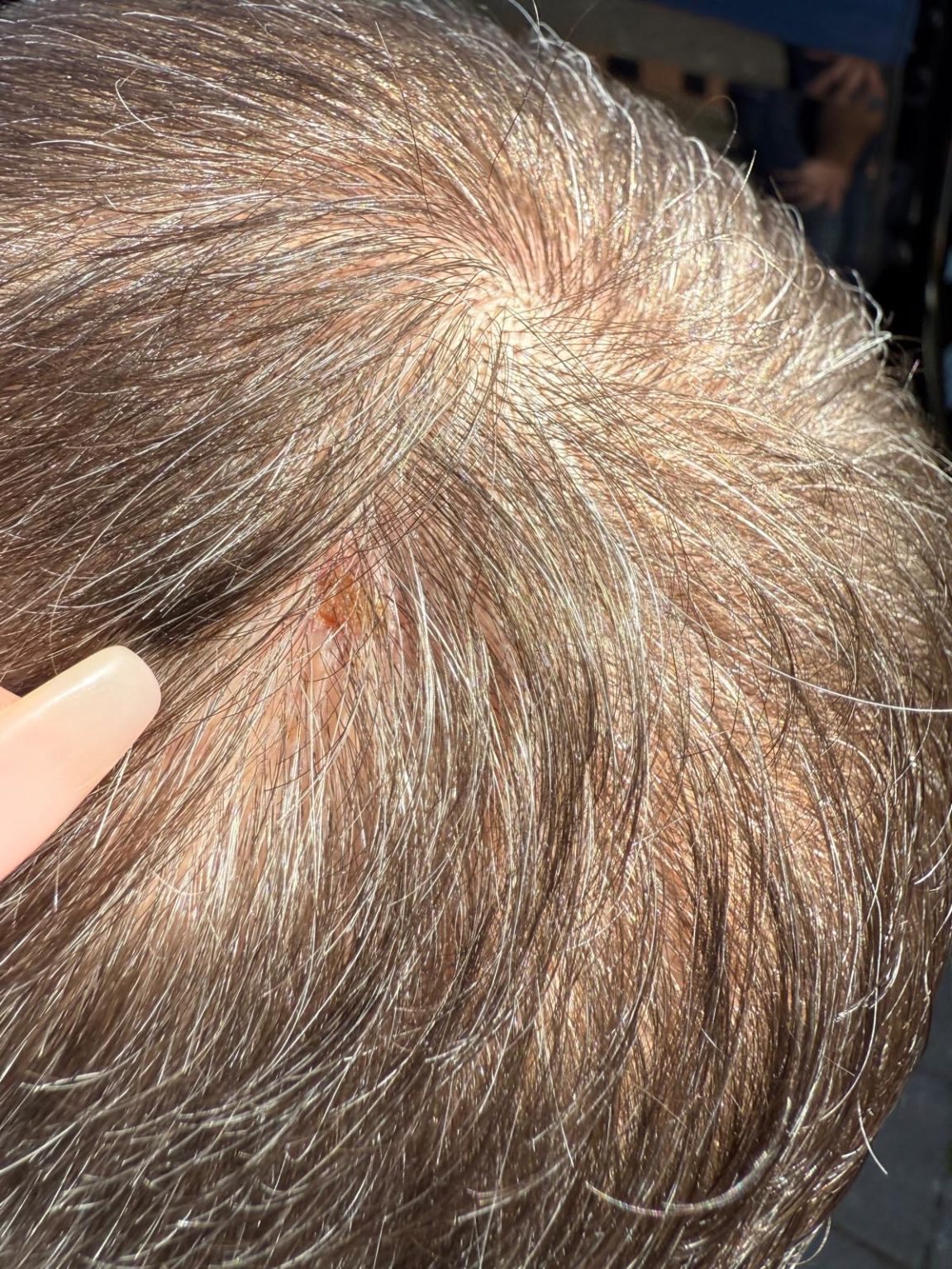 Intradermal Neavus - Scalp