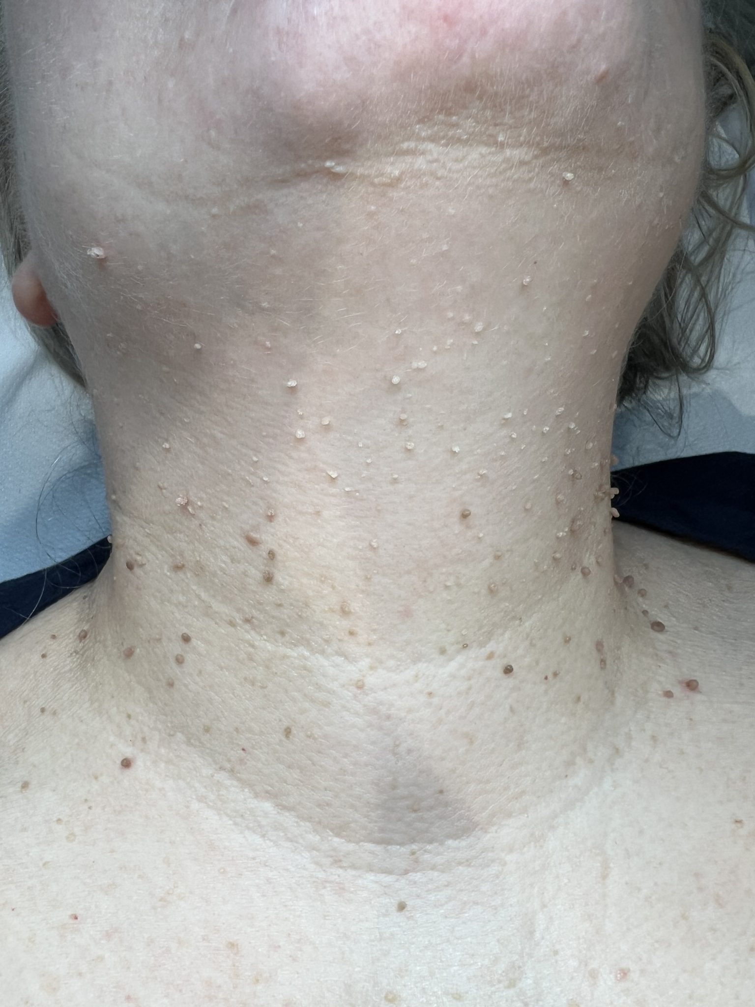 Skin Tags & Filiform Warts on the Neck | Amy Gordon
